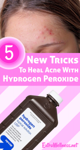 Acne lowering your self esteem: Using Hydrogen Peroxide for acne